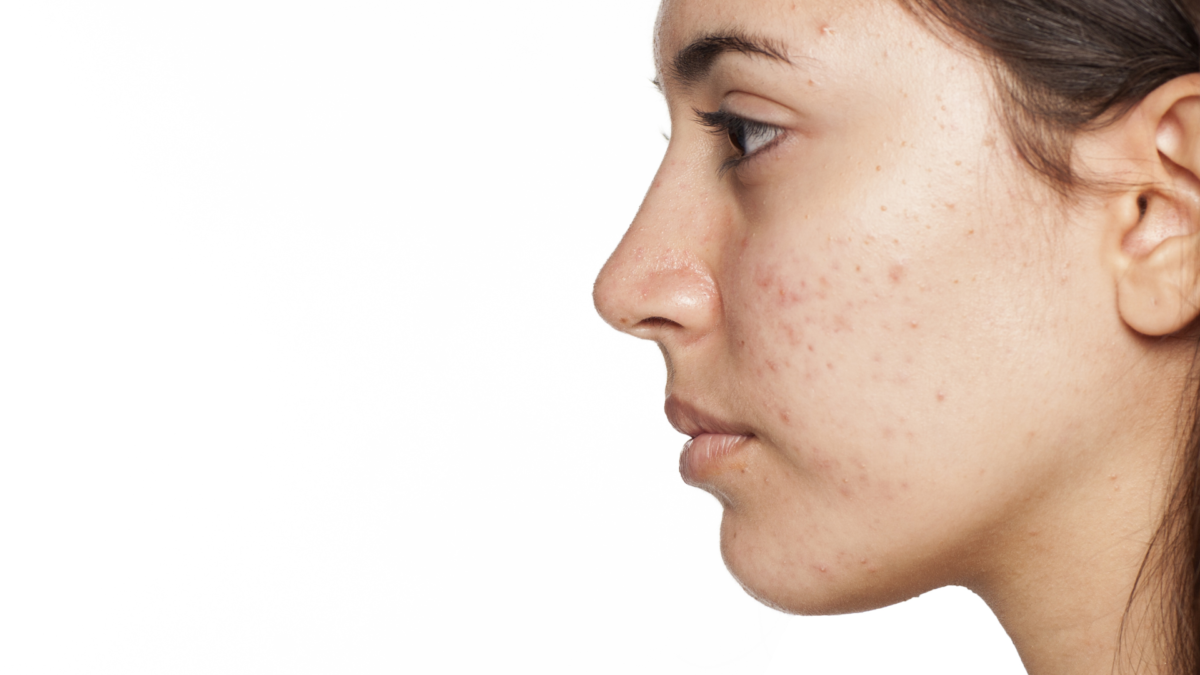 Pimples on Face